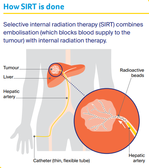 Comprehensive Treatment Options for Secondary Liver Cancer - Cancer ...