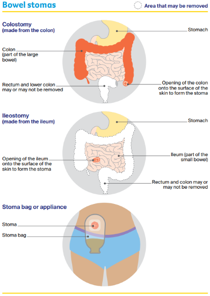 Living with a Stoma | Types, Bags, and Support for Bowel Cancer