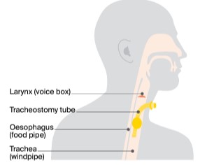 Side Effects of Head and Neck Cancers | Cancer Council Victoria