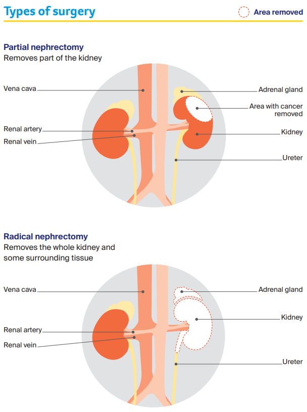Comprehensive Guide to Early Kidney Cancer Treatments