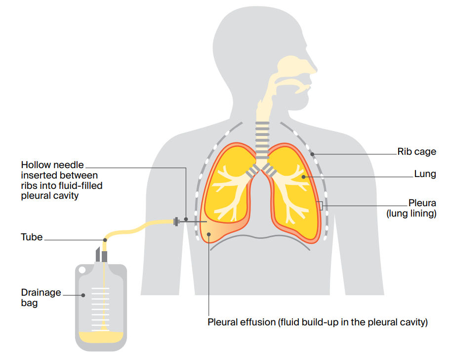 Managing mesothelioma symptoms