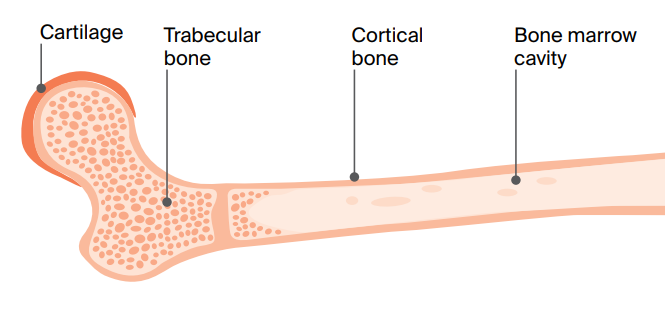 Bone Cancer Diagram