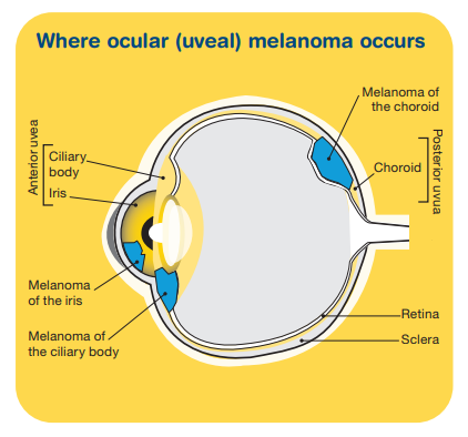 Ocular Melanoma (Uveal) - Check Types of Eye Cancer, Symptoms ...