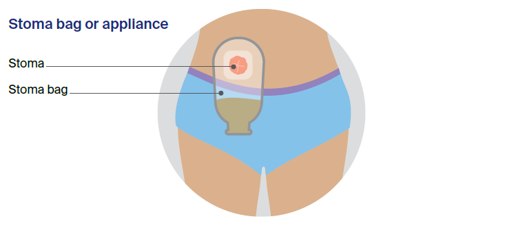 Having a stoma - Cancer Council Victoria